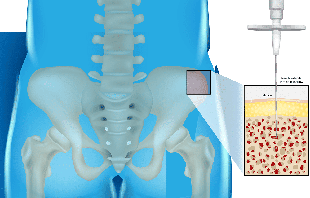 Medula óssea: confira mitos e verdades sobre a doação - Olhar Digital