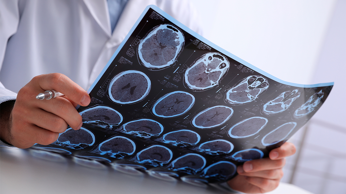 Genes ancestrais desvendam mistério sobre esclerose, diz estudo